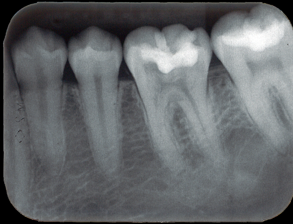 A fogászati röntgen bemutatása – típusok, alkalmazási területek - Dentabo